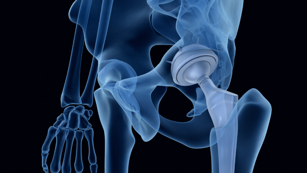 Total Joint Replacement Technology, Building Bionic People – Avid Home ...